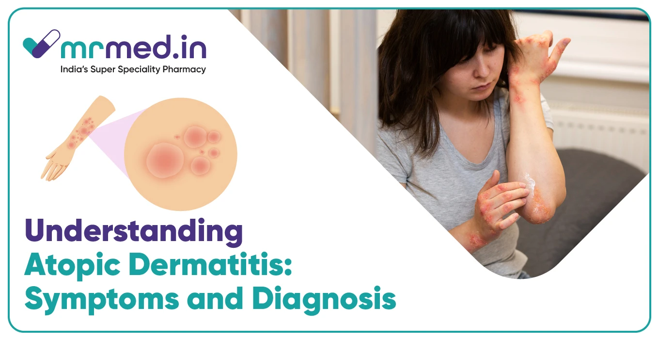Early Signs of Atopic Dermatitis: Symptoms, Stages & Diagnosis