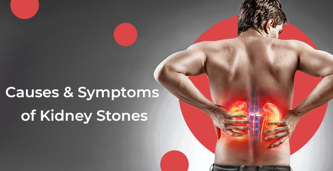 Kidney Stone Symptoms And Causes | MrMed
