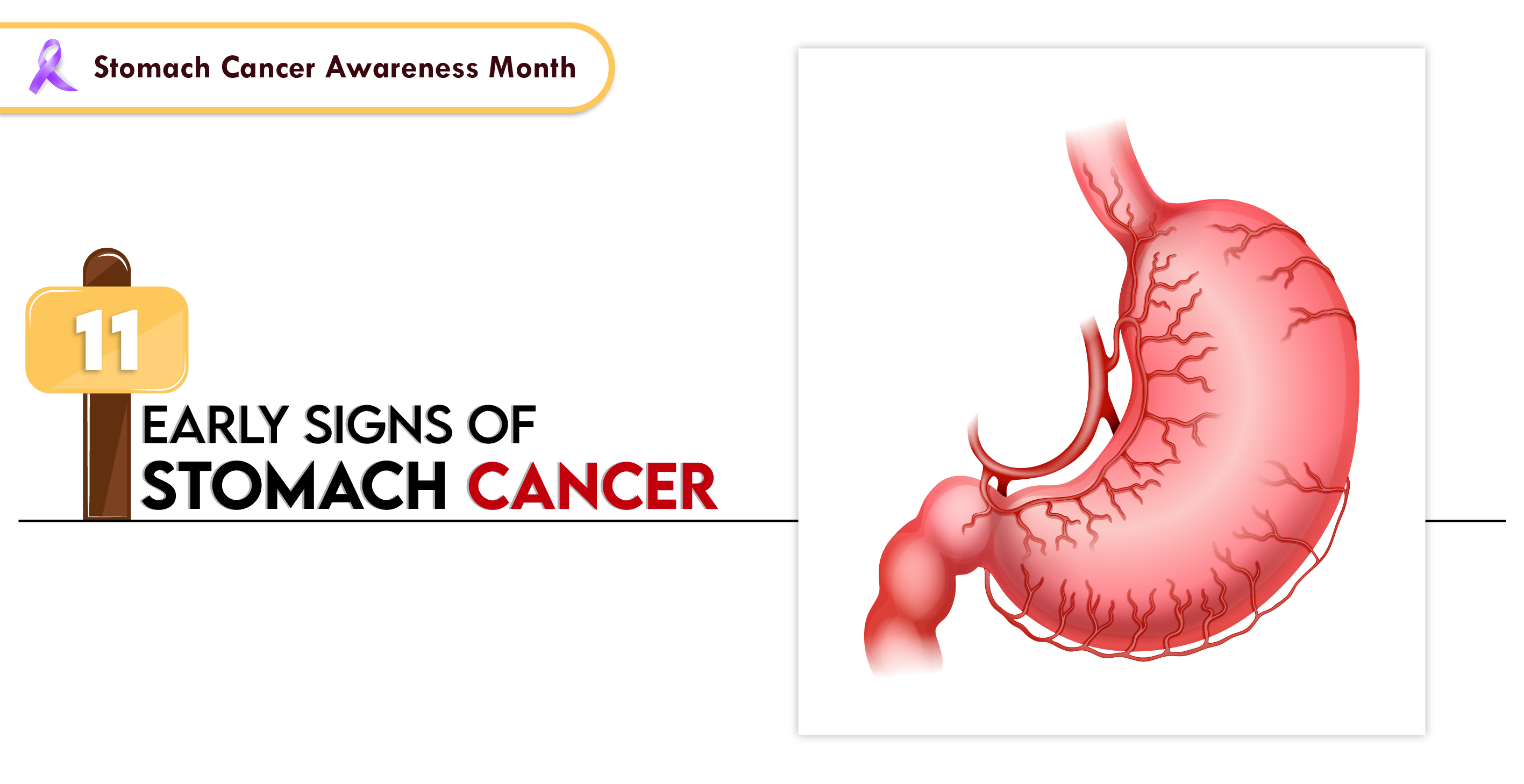 11 Common Early Signs Of Stomach Cancer | MrMed