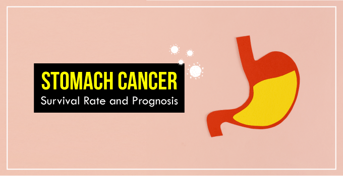 Survival Rate And Prognosis Of Stomach Cancer | MrMed